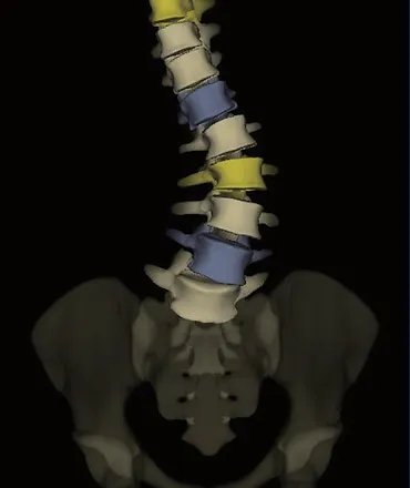 Scoliosis Treatment in Hong Kong – NYMG